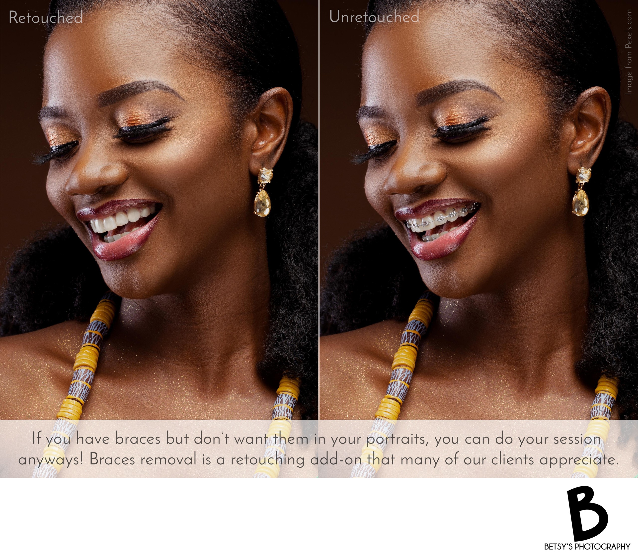 Acne, Blemishes, and Braces - Betsy's Photography